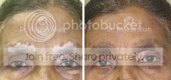Vitiligo – Causes Symptoms and Treatment – edwardoambrose3's Blog
